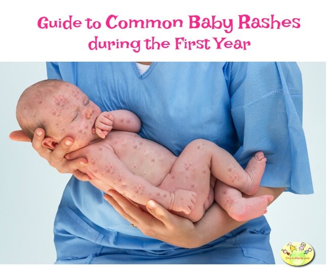 Common Baby Rashes During The First Year Common Baby Rashes During The First Year